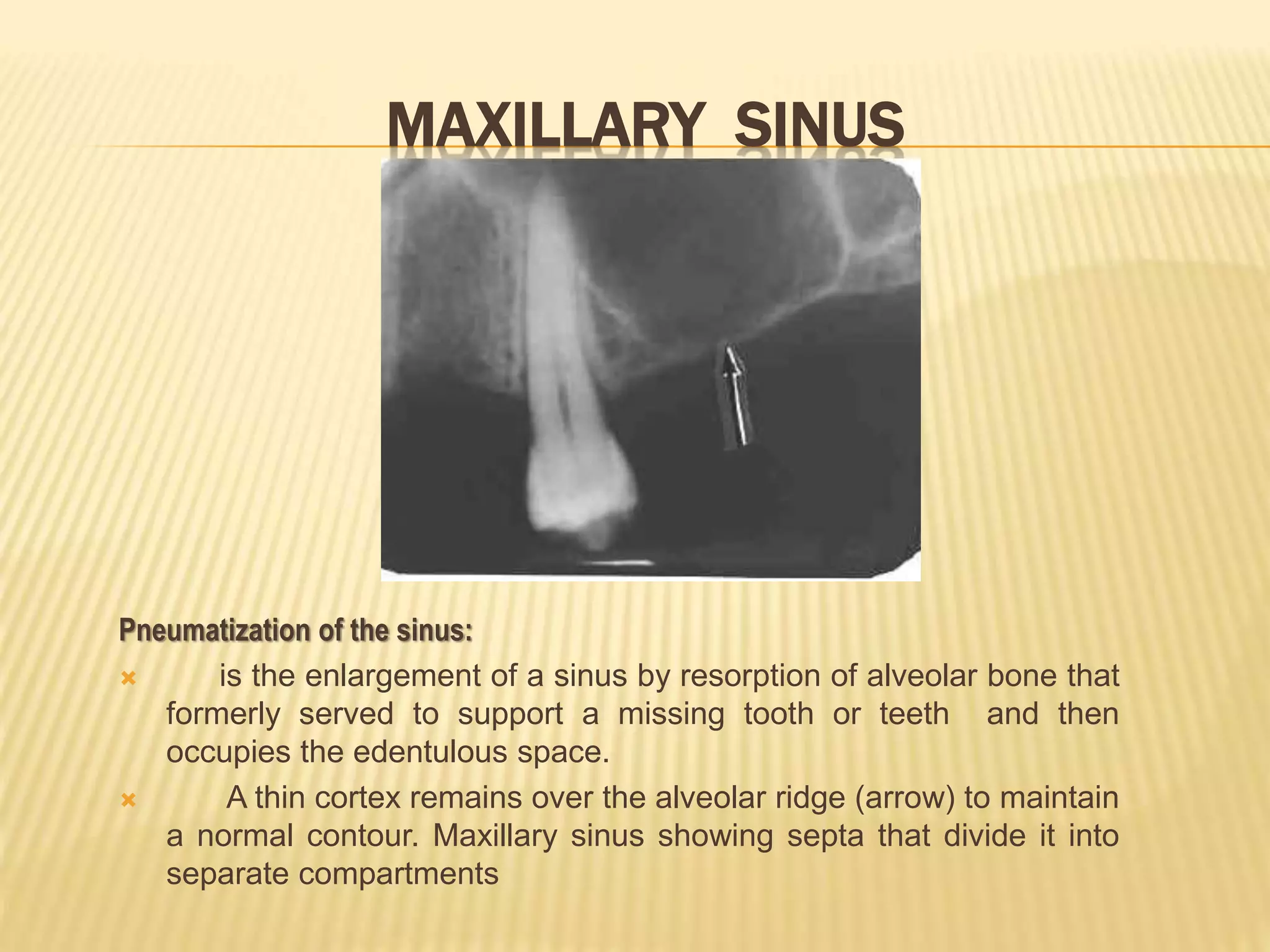 Max sinus smitha | PPTX | Ear, Nose and Throat Conditions | Diseases ...