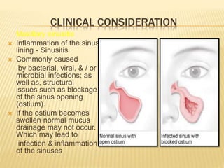 Max sinus smitha | PPTX | Ear, Nose and Throat Conditions | Diseases ...