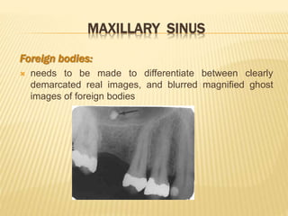 Max sinus smitha | PPTX | Ear, Nose and Throat Conditions | Diseases ...