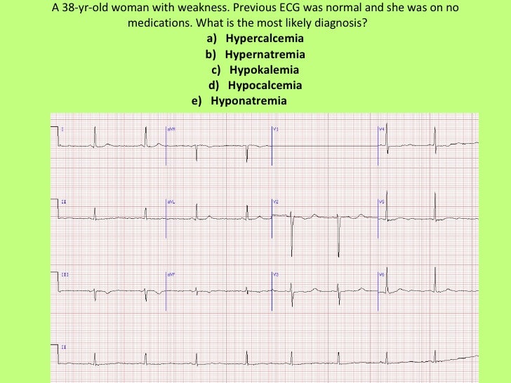 Hypernatremia Ecg 1000+ Images About Nursing: NCLEX On Pinterest ...