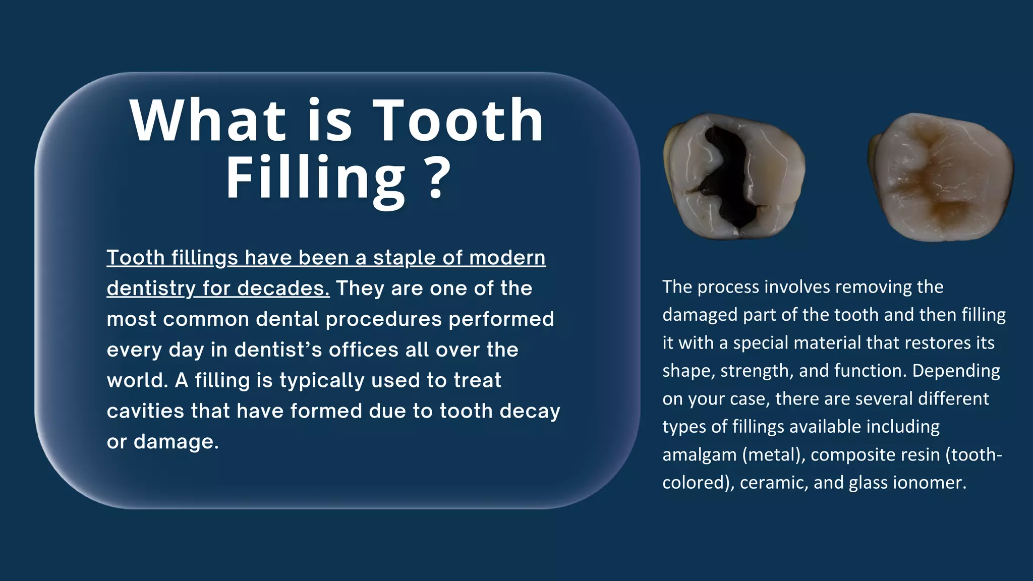 Benefits of Tooth Filling | PPT