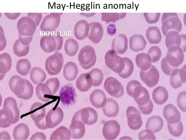 May Hegglin Anomaly