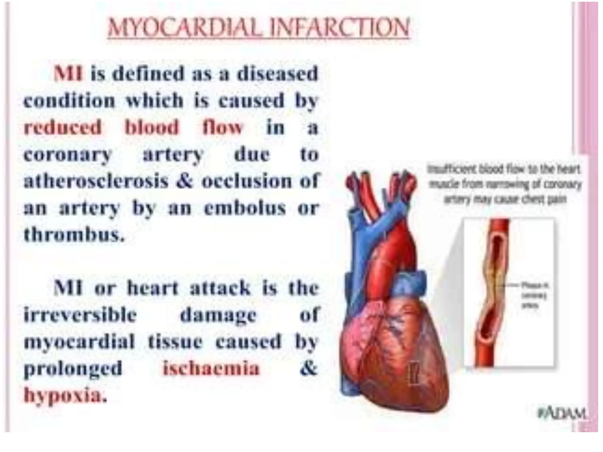 mayocardial infraction heart disease.pptx