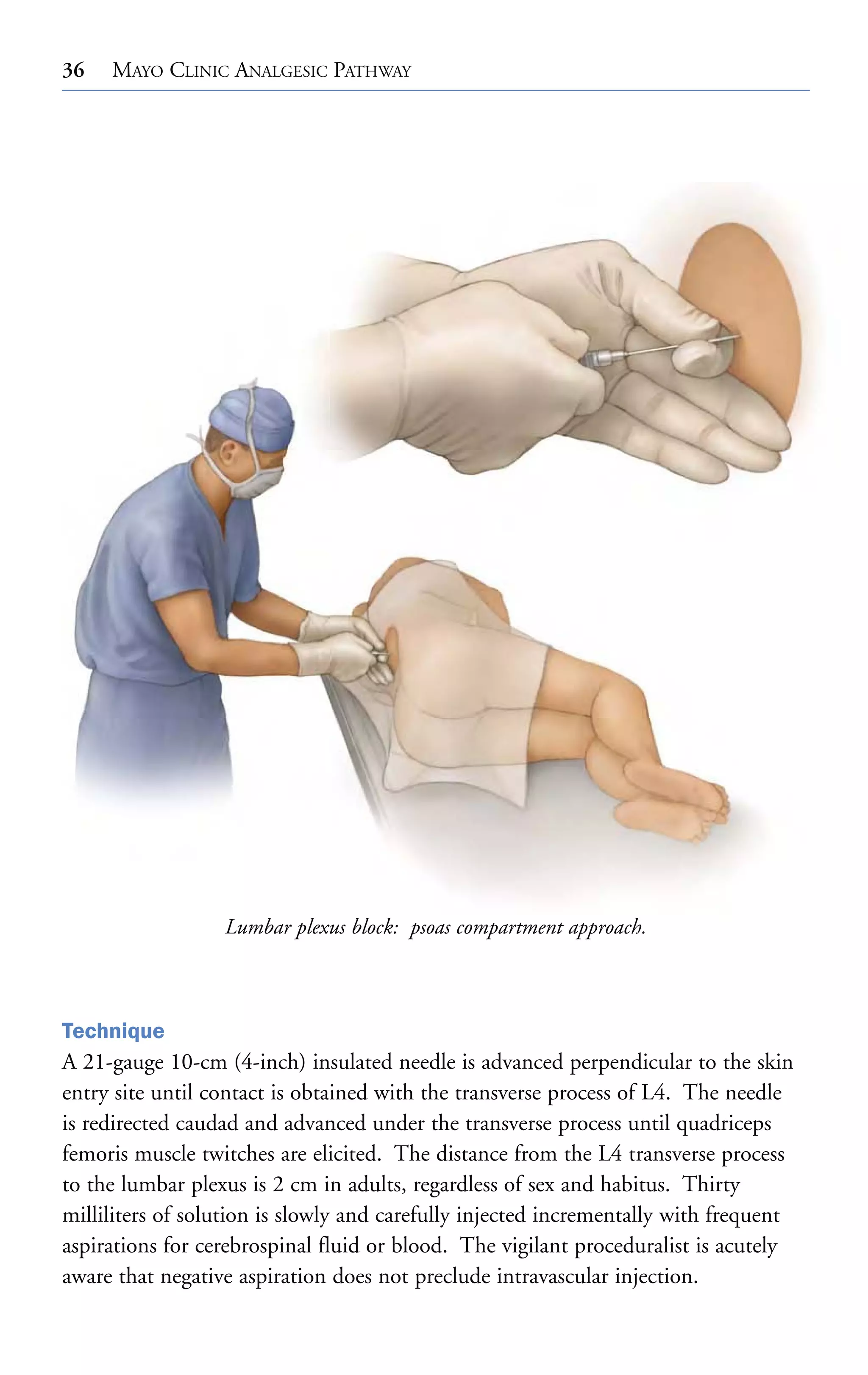 Mayo clinic analgesic pathway peripheral nerve blockade | PDF