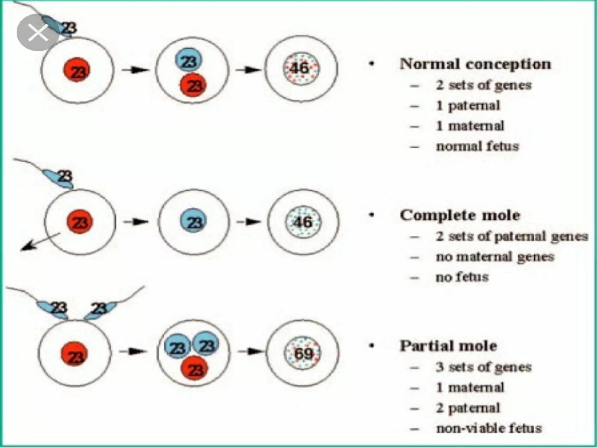 hydatidiform mole | PPT