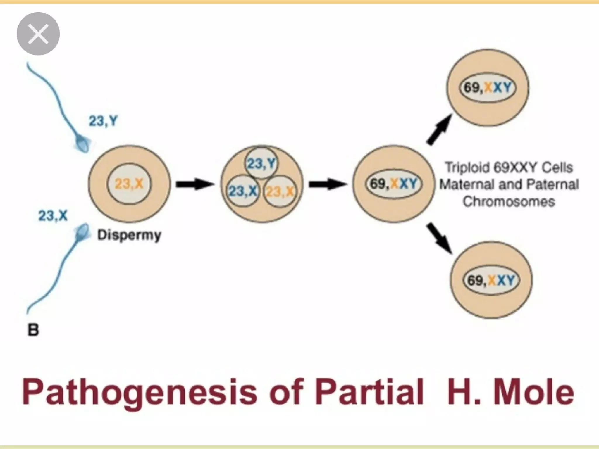 hydatidiform mole | PPT