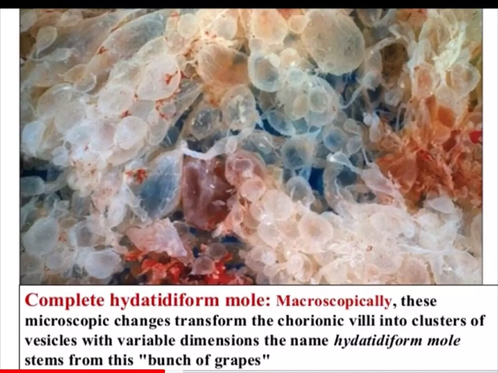 hydatidiform mole | PPT