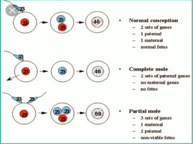 hydatidiform mole | PPT