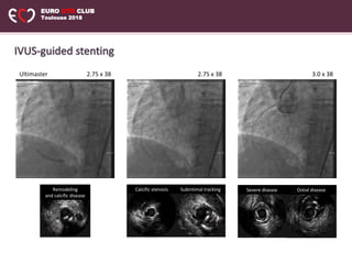 J CTO score ≥3 | PPT