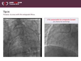 J CTO score ≥3 | PPTX
