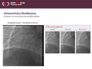 J CTO score ≥3 | PPTX