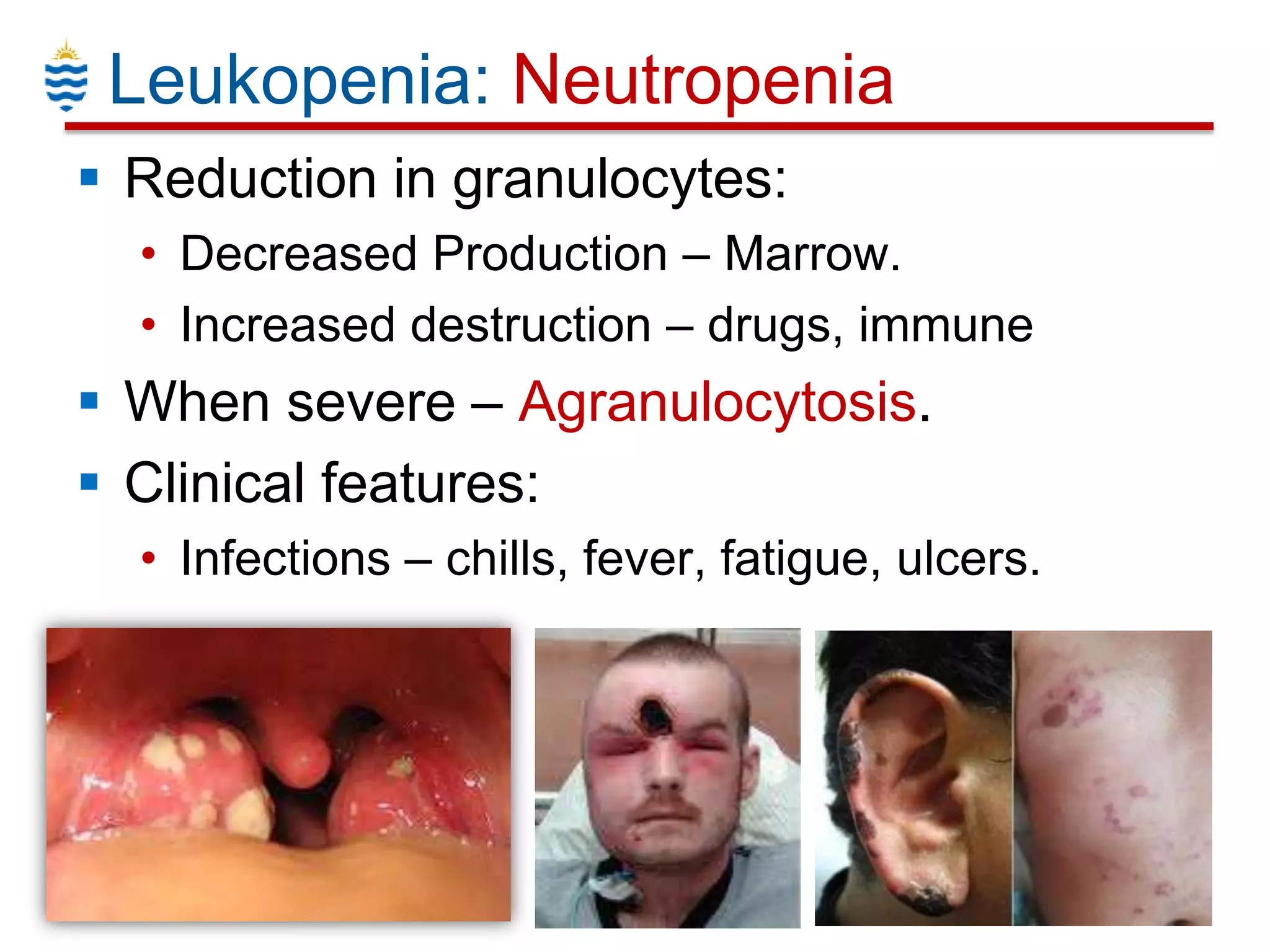 Pathology of WBC Disorders | PPTX