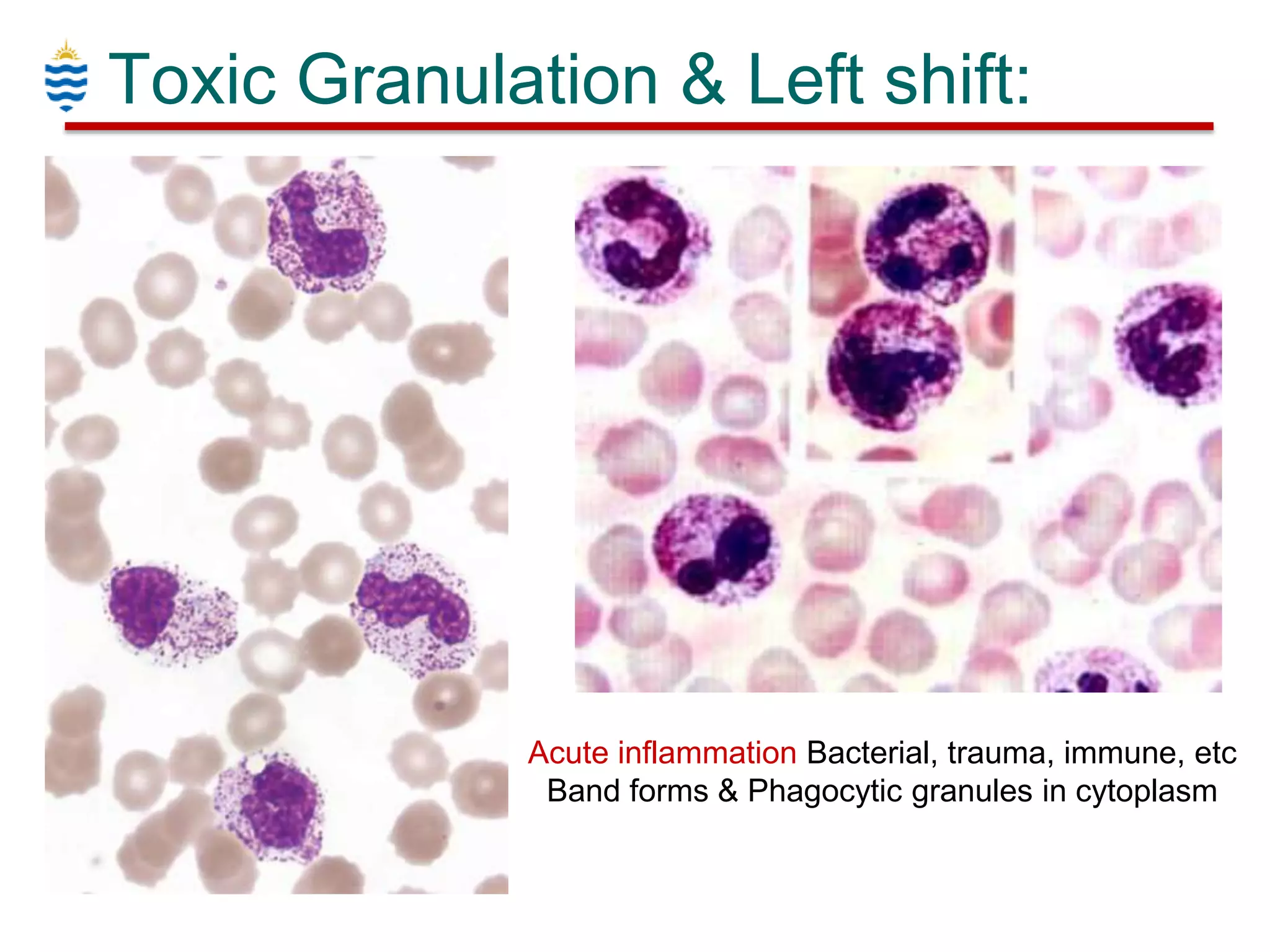 Pathology of WBC Disorders | PPTX