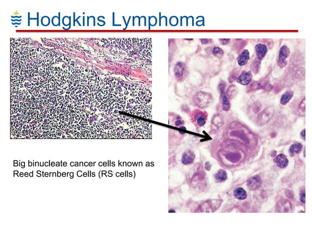 Pathology of WBC Disorders | PPTX | Blood Disorders | Diseases and ...