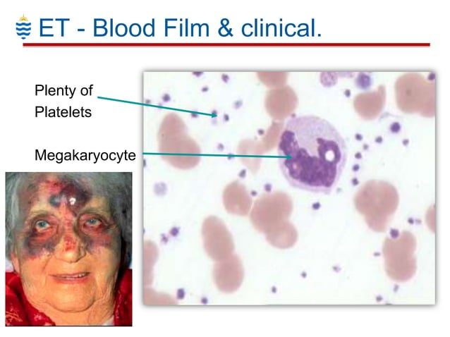 Pathology of WBC Disorders | PPTX | Blood Disorders | Diseases and ...