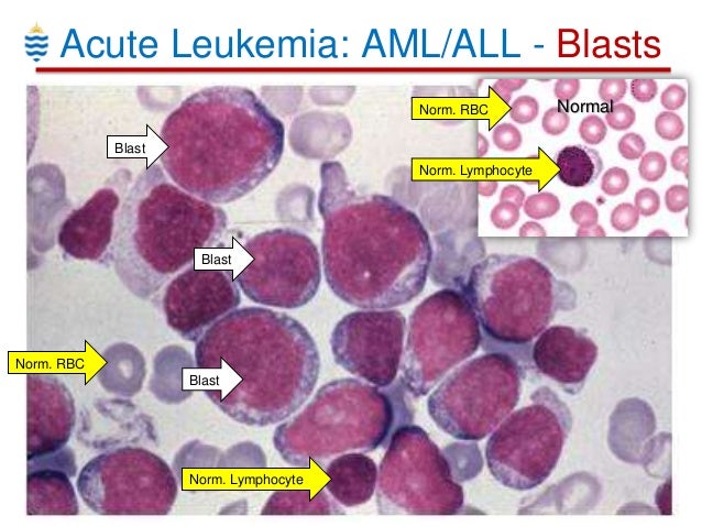 Pathology of WBC Disorders