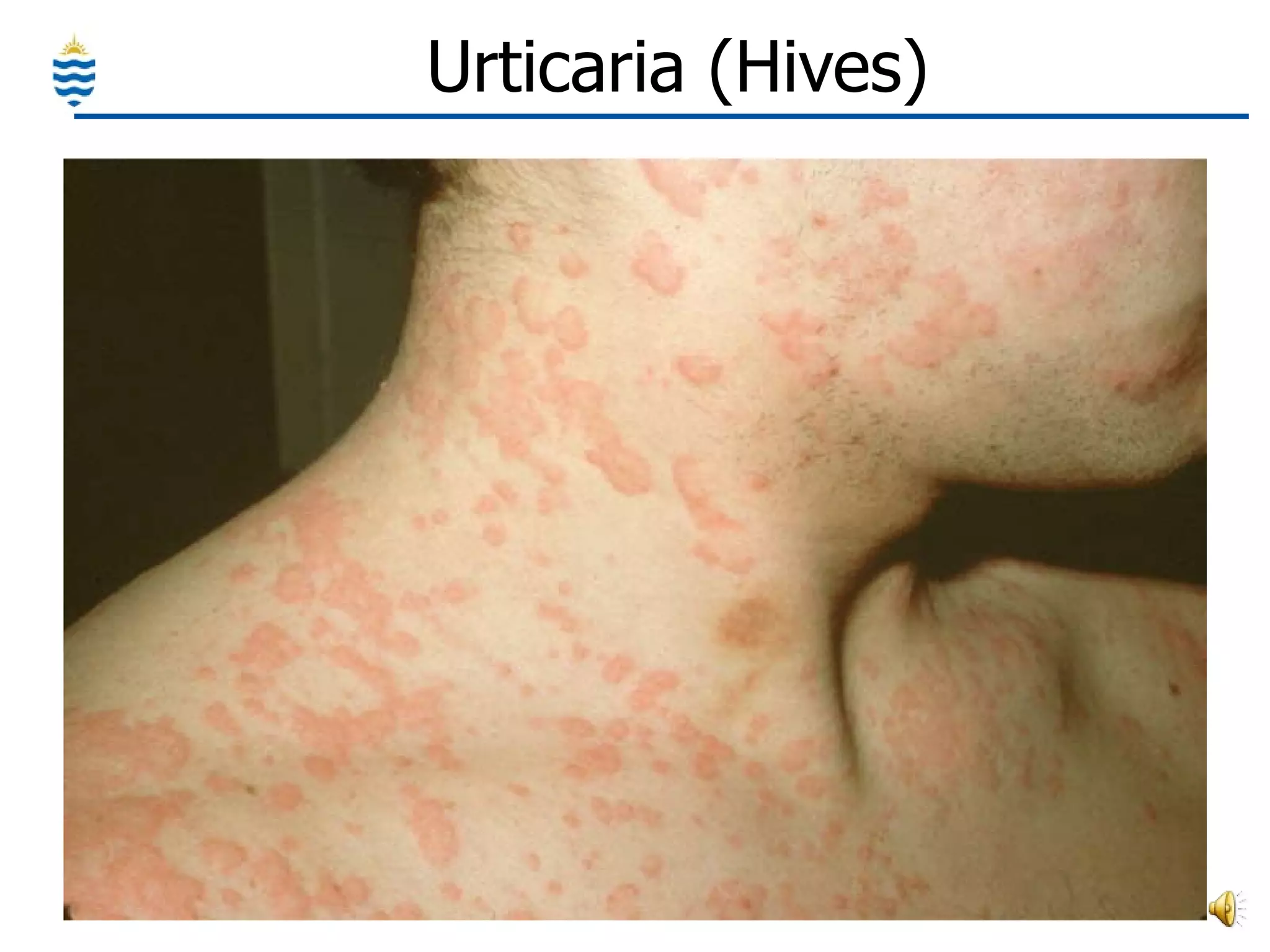 Pathology of Skin - Common Disorders | PPT