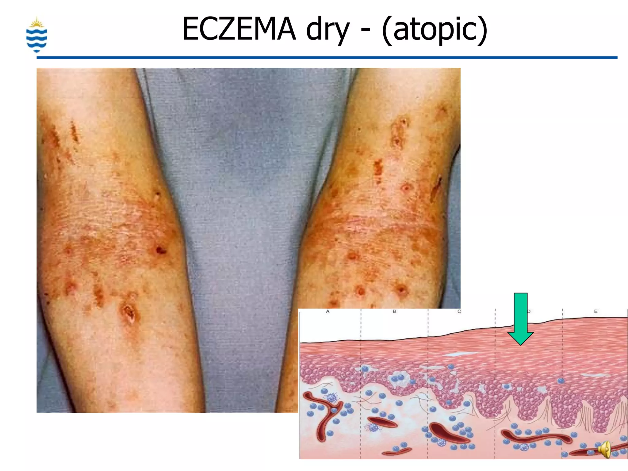 Pathology of Skin - Common Disorders | PPT