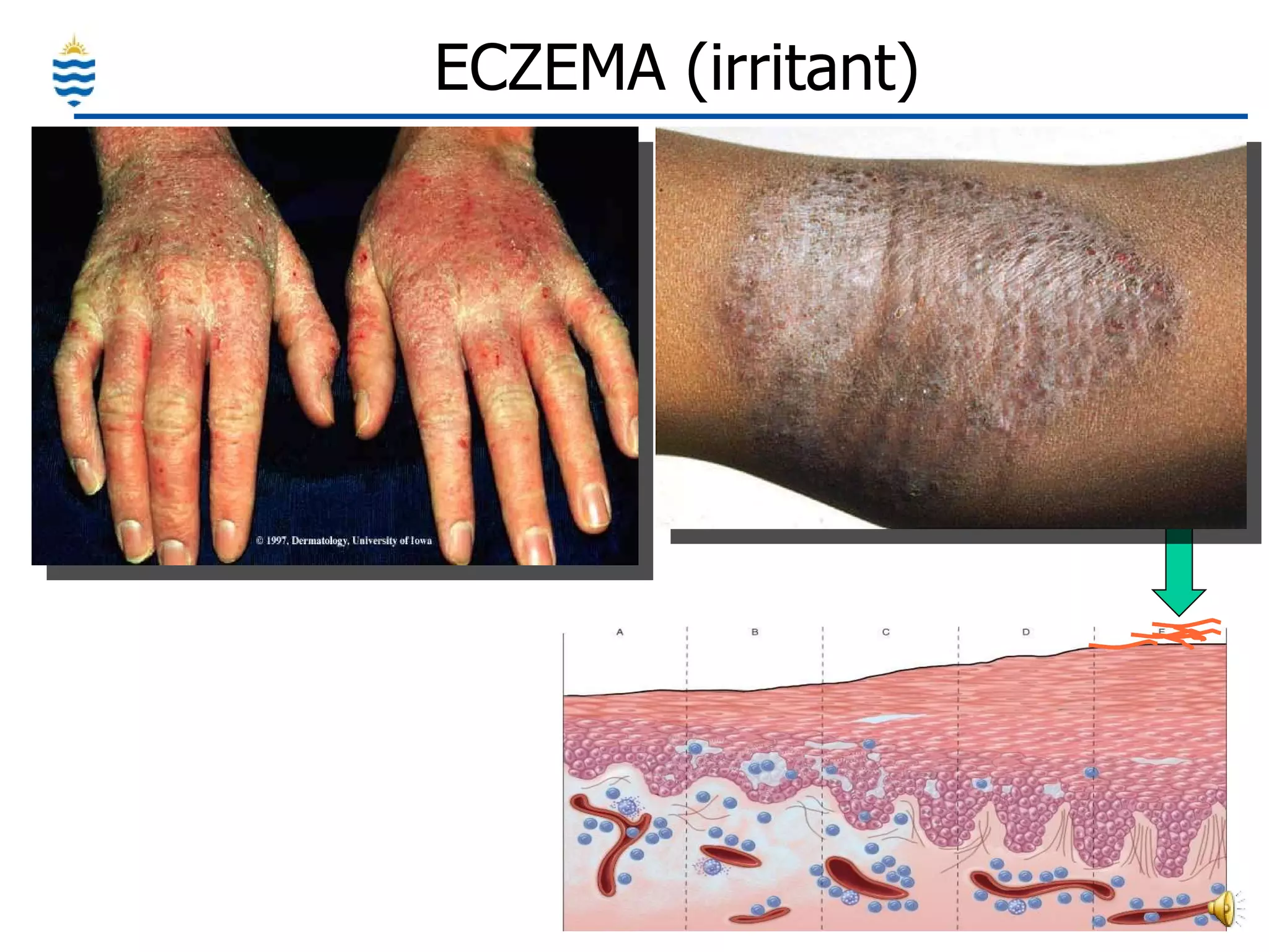 Pathology of Skin - Common Disorders | PPT
