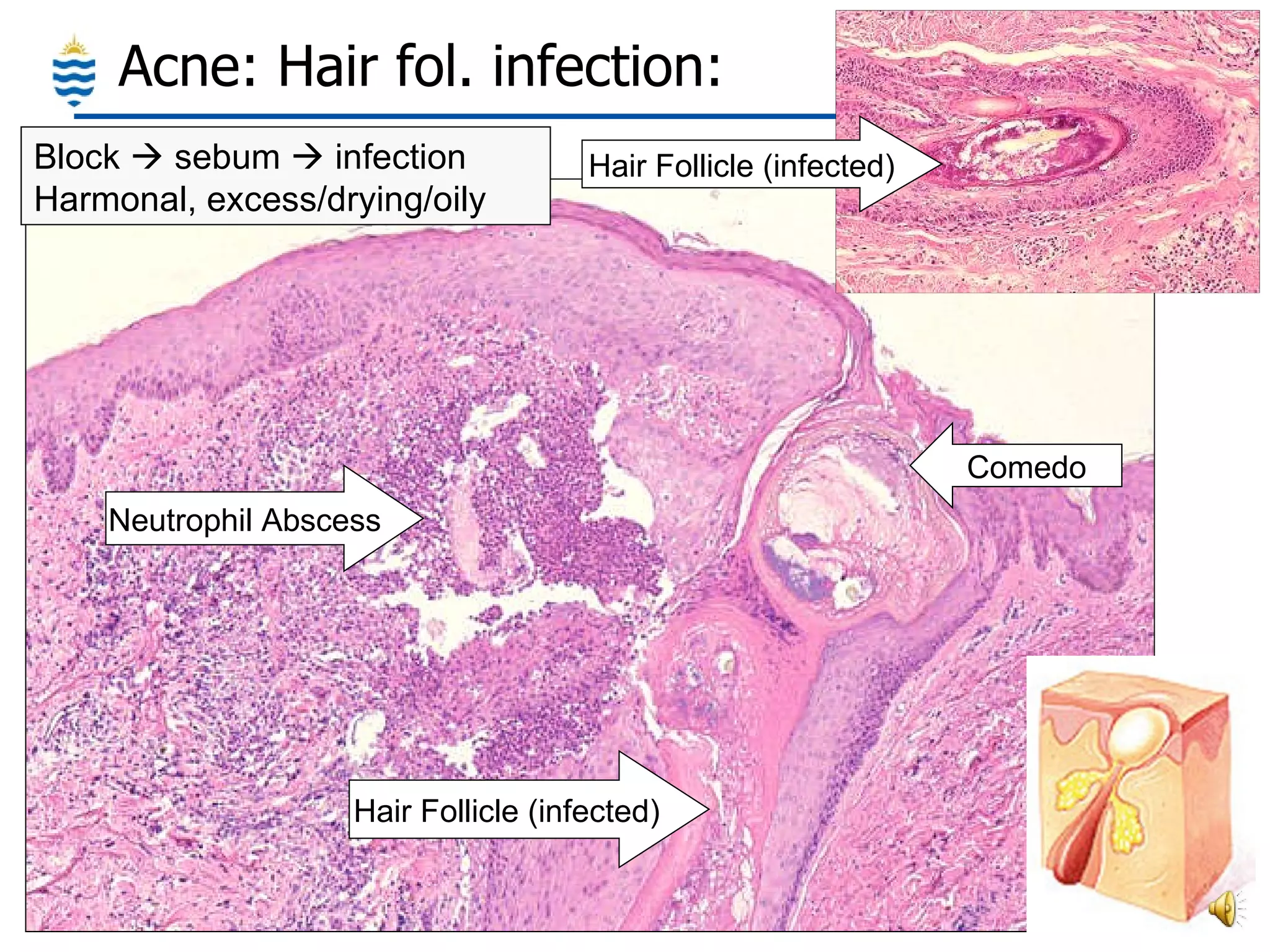 Pathology of Skin - Common Disorders | PPT