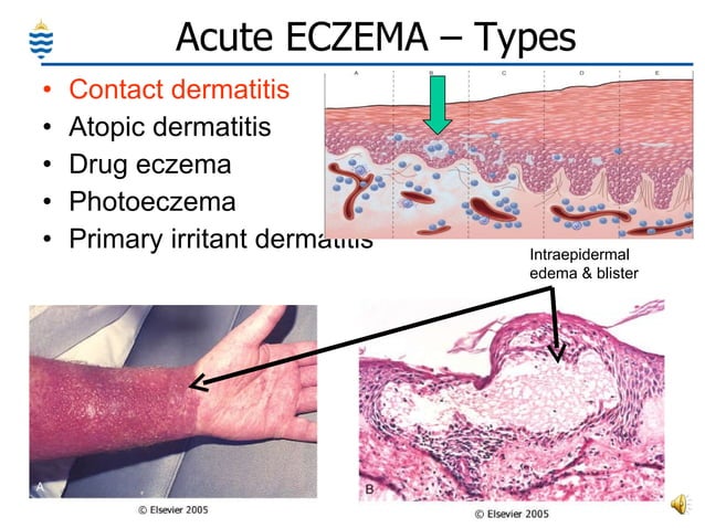 Pathology of Skin - Common Disorders | PPT
