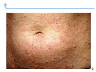 Pathology of Skin - Common Disorders | PPT