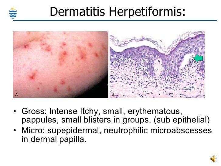 Pathology of Skin - Common Disorders
