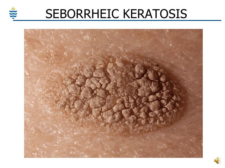 Pathology of Skin - Common Disorders