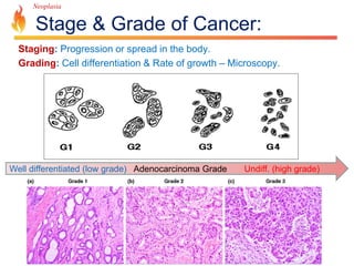 Pathology Lecture - Neoplasia | PPTX