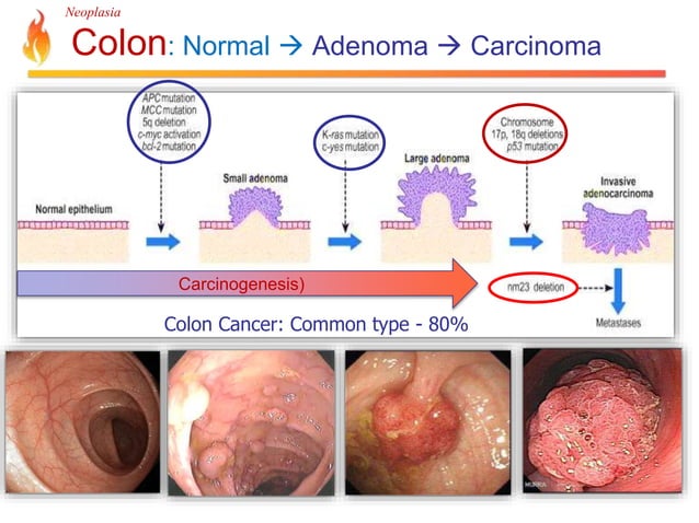 Pathology Lecture - Neoplasia