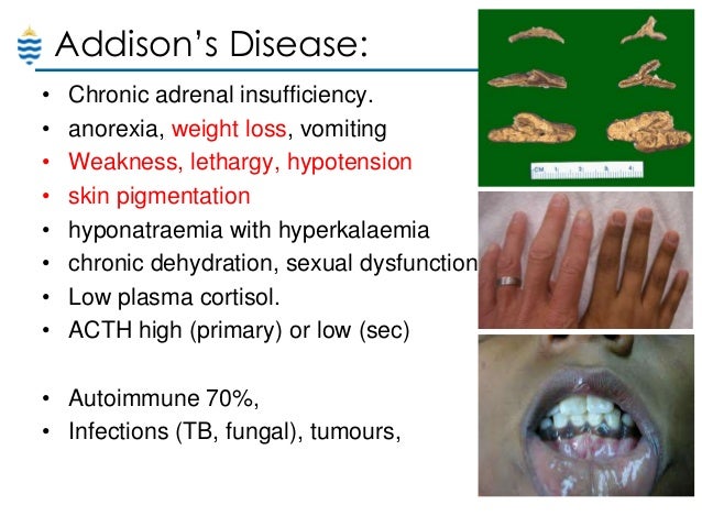 Addison's disease adrenaline - discosno