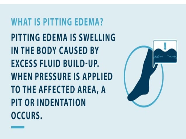MBBS First year assessment of edema.pptx