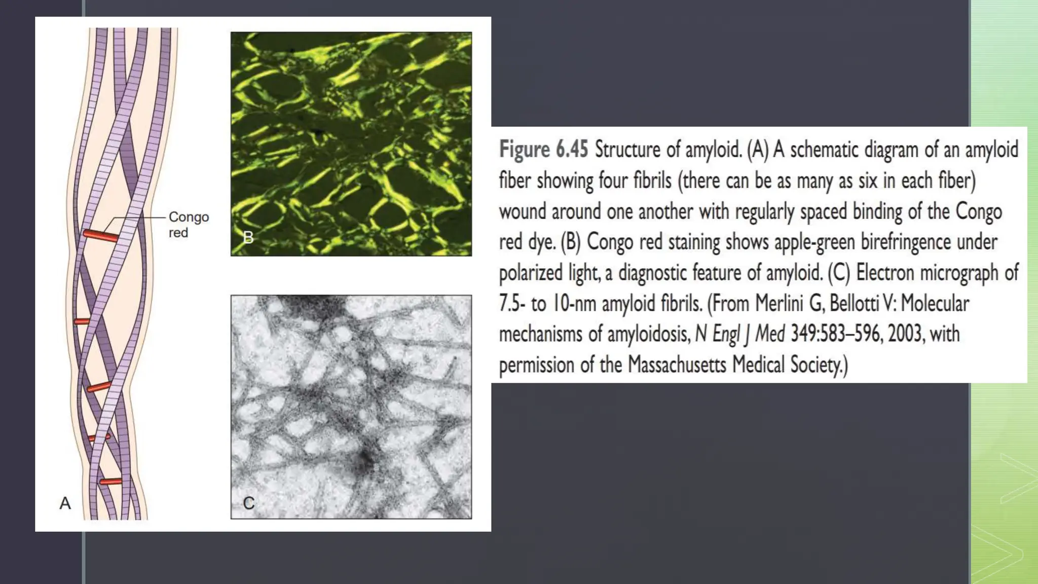 MBBS PPT - AMYLOIDOSIS types diagnostic approach and staining ...