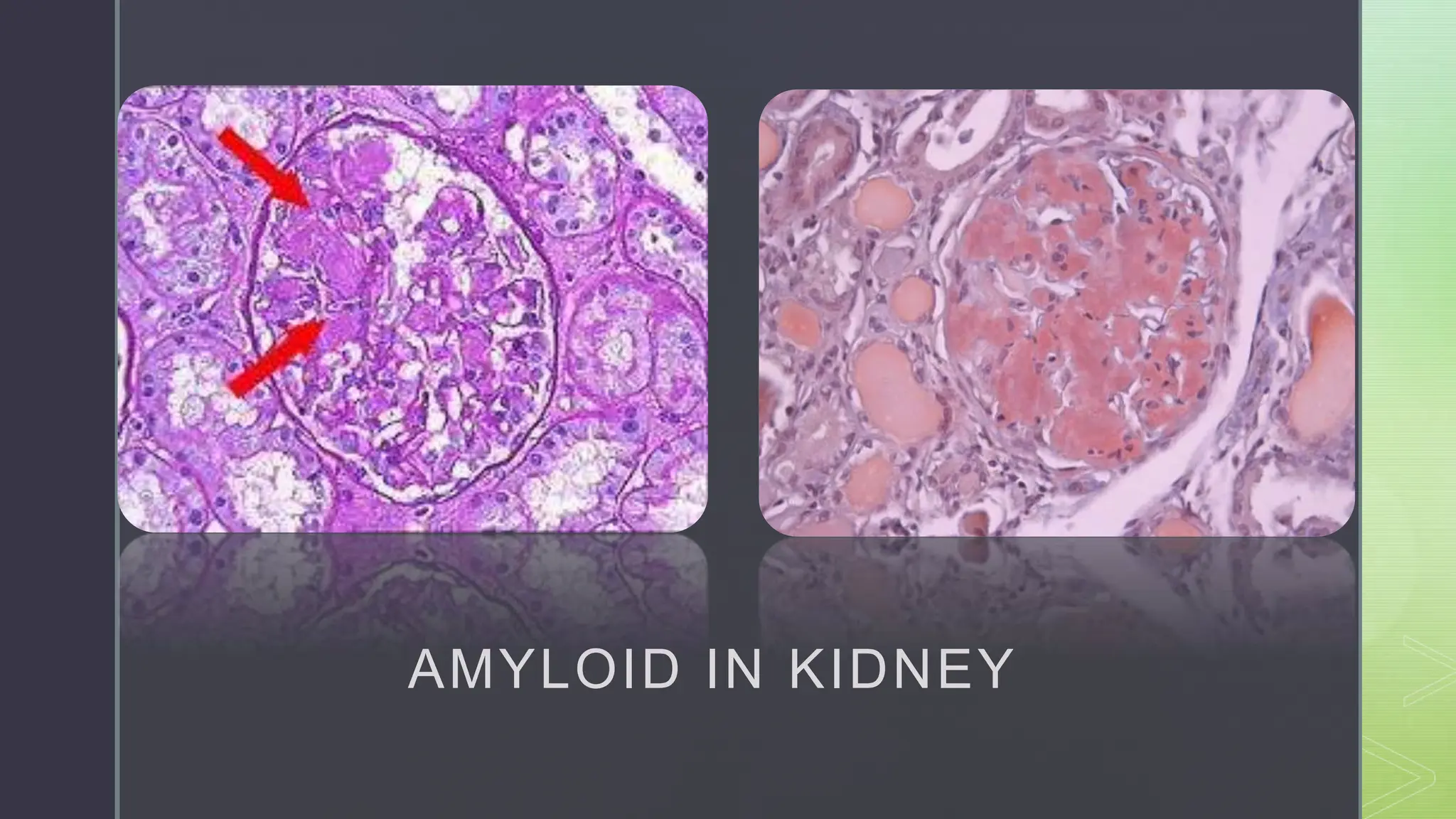 MBBS PPT - AMYLOIDOSIS types diagnostic approach and staining ...