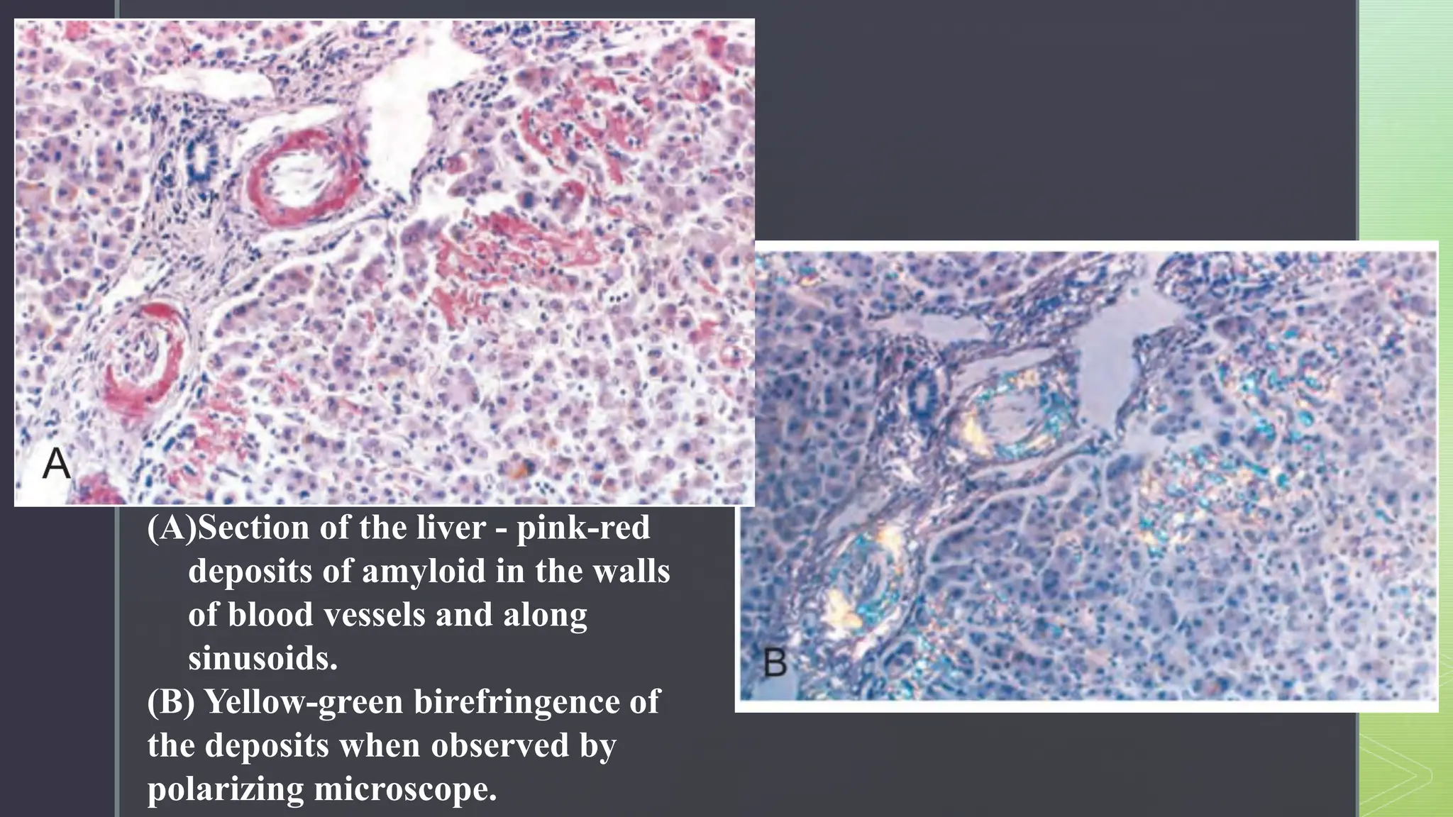 MBBS PPT - AMYLOIDOSIS types diagnostic approach and staining ...