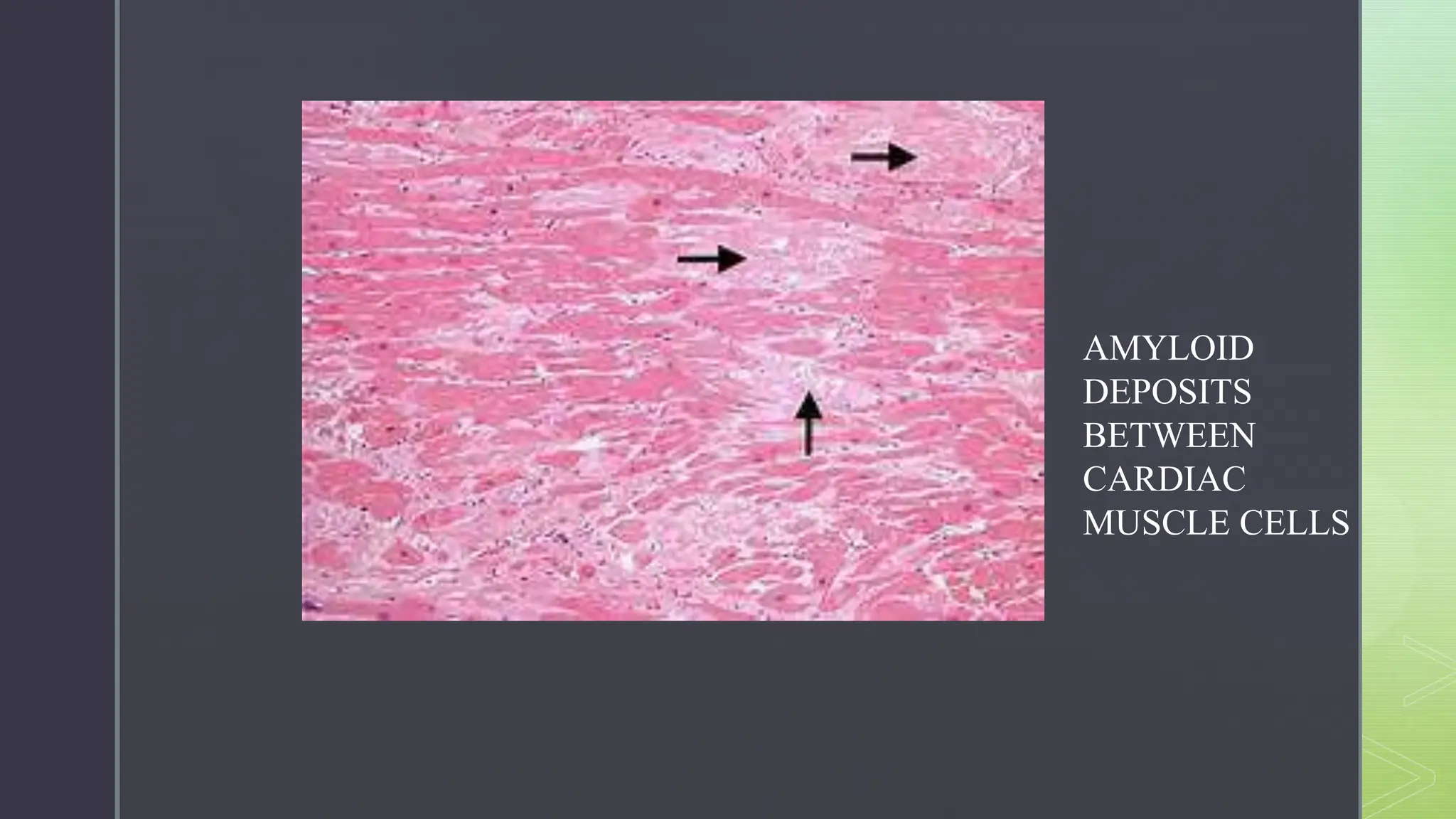 MBBS PPT - AMYLOIDOSIS types diagnostic approach and staining ...