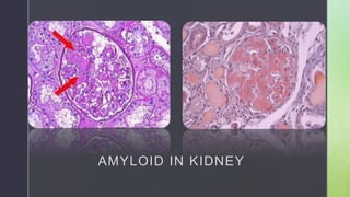 MBBS PPT - AMYLOIDOSIS types diagnostic approach and staining ...