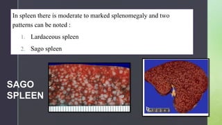 MBBS PPT - AMYLOIDOSIS types diagnostic approach and staining ...