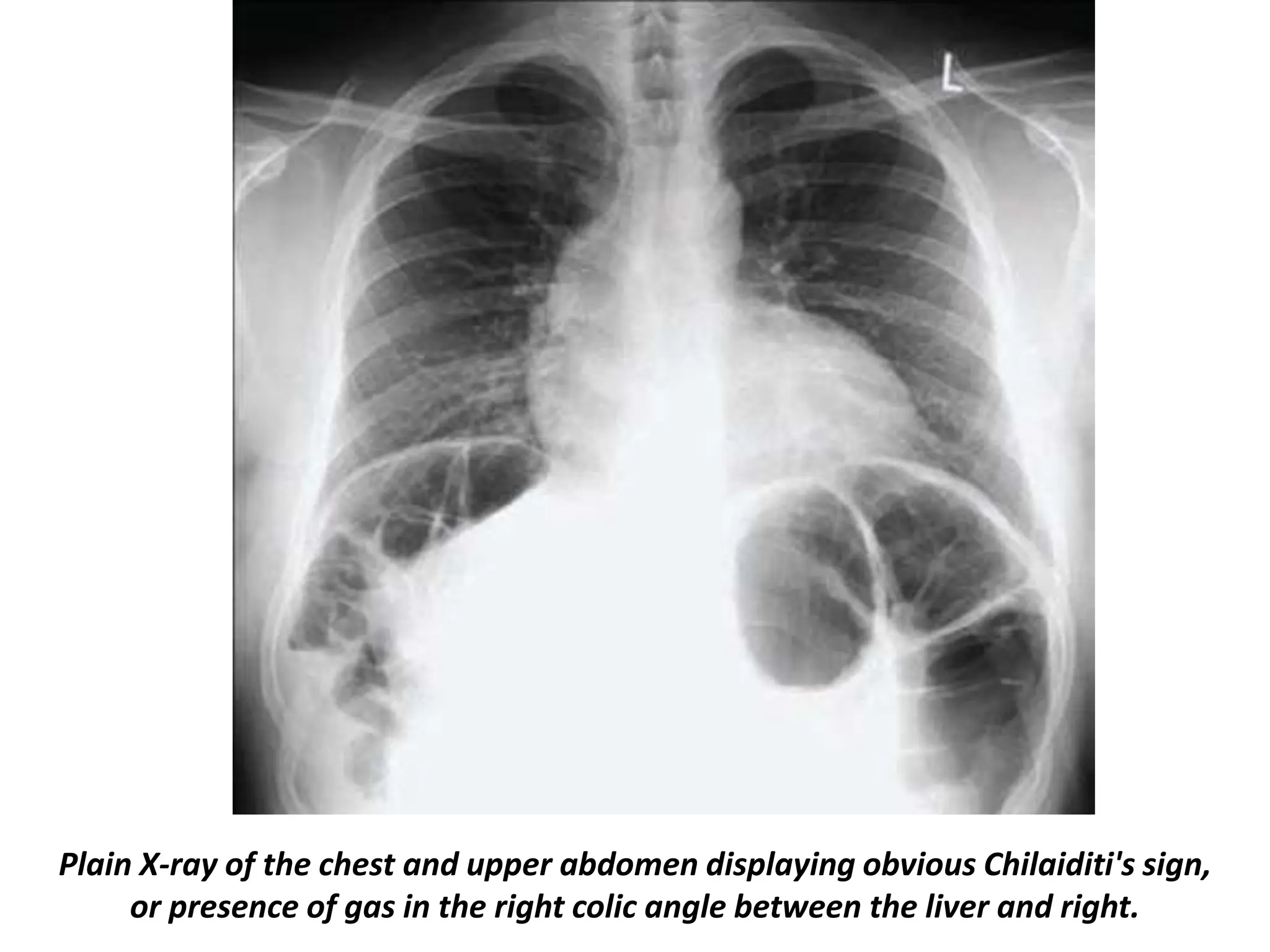 Medicine approach to plain abdominal XRAYS.pptx