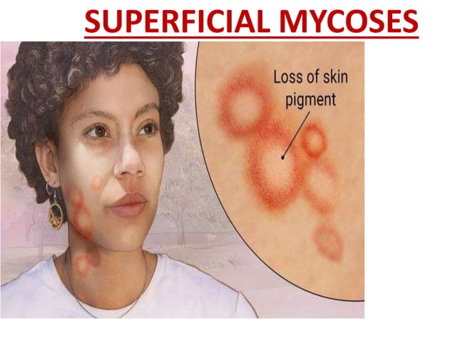 Introduction to superficial mycoses Apr2024.ppt