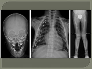 Imaging In Metabolic Bone Diseases | PPTX