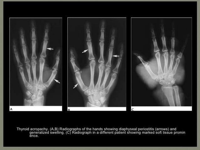 Imaging In Metabolic Bone Diseases | PPTX | Bone and Joint Conditions | Diseases and Conditions