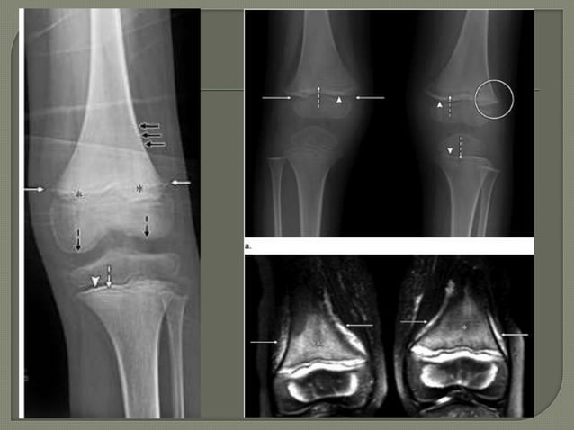 Imaging In Metabolic Bone Diseases | PPTX | Bone and Joint Conditions ...