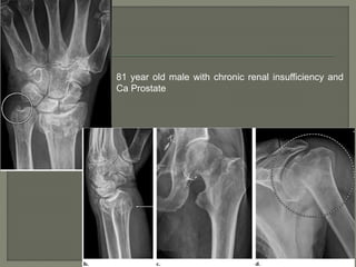 Imaging In Metabolic Bone Diseases | PPTX