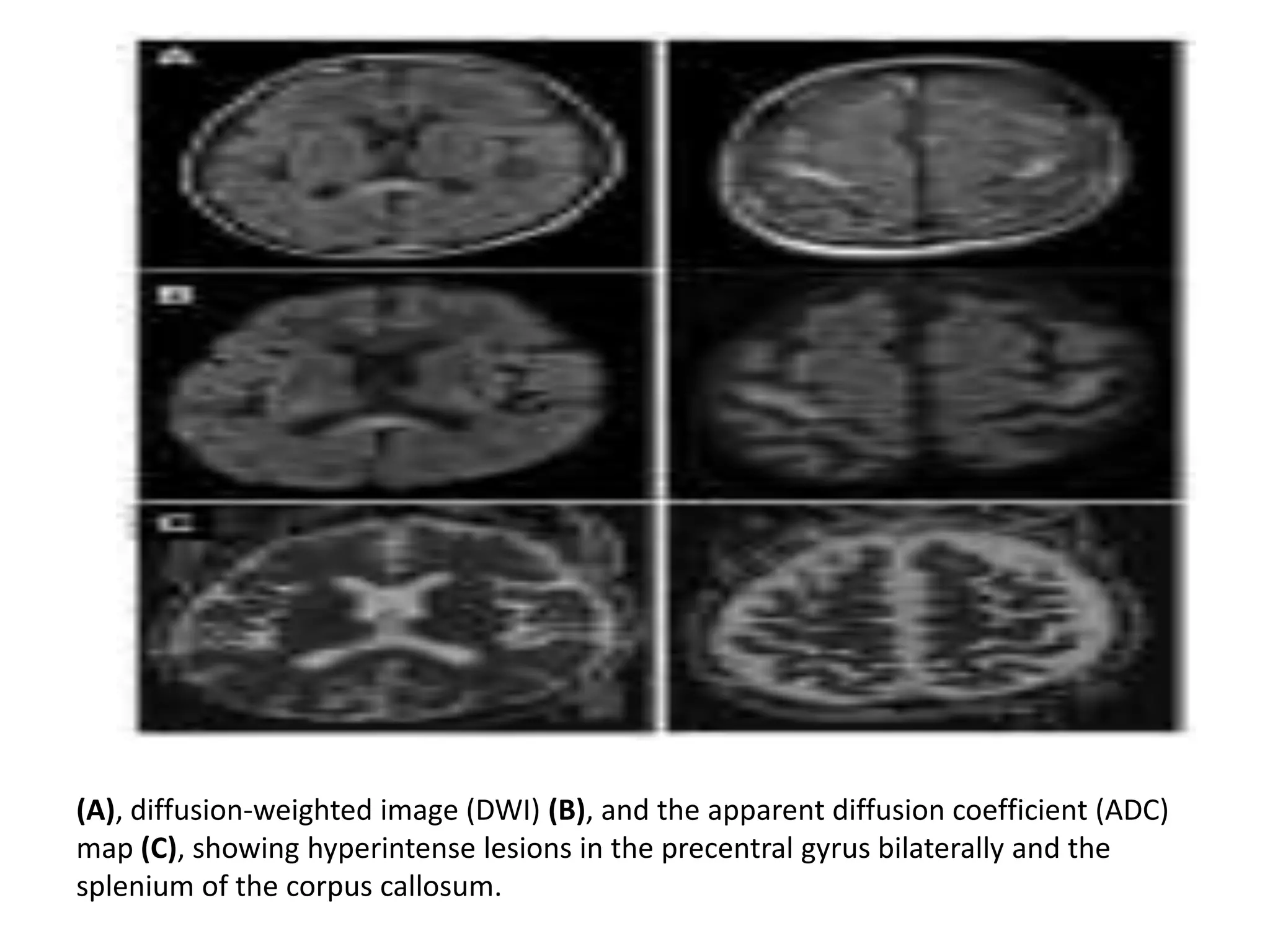Marchiafava–Bignami disease (MBD) | PPTX