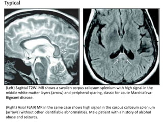 Marchiafava Bignami Disease Mbd Pptx
