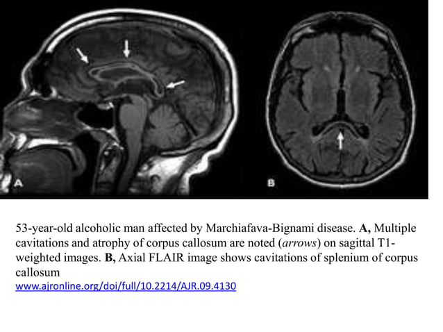Marchiafava–Bignami disease (MBD) | PPTX | Brain and Nervous System ...
