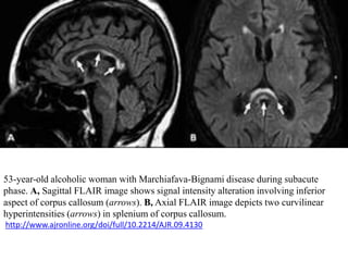 Marchiafava–Bignami disease (MBD) | PPTX