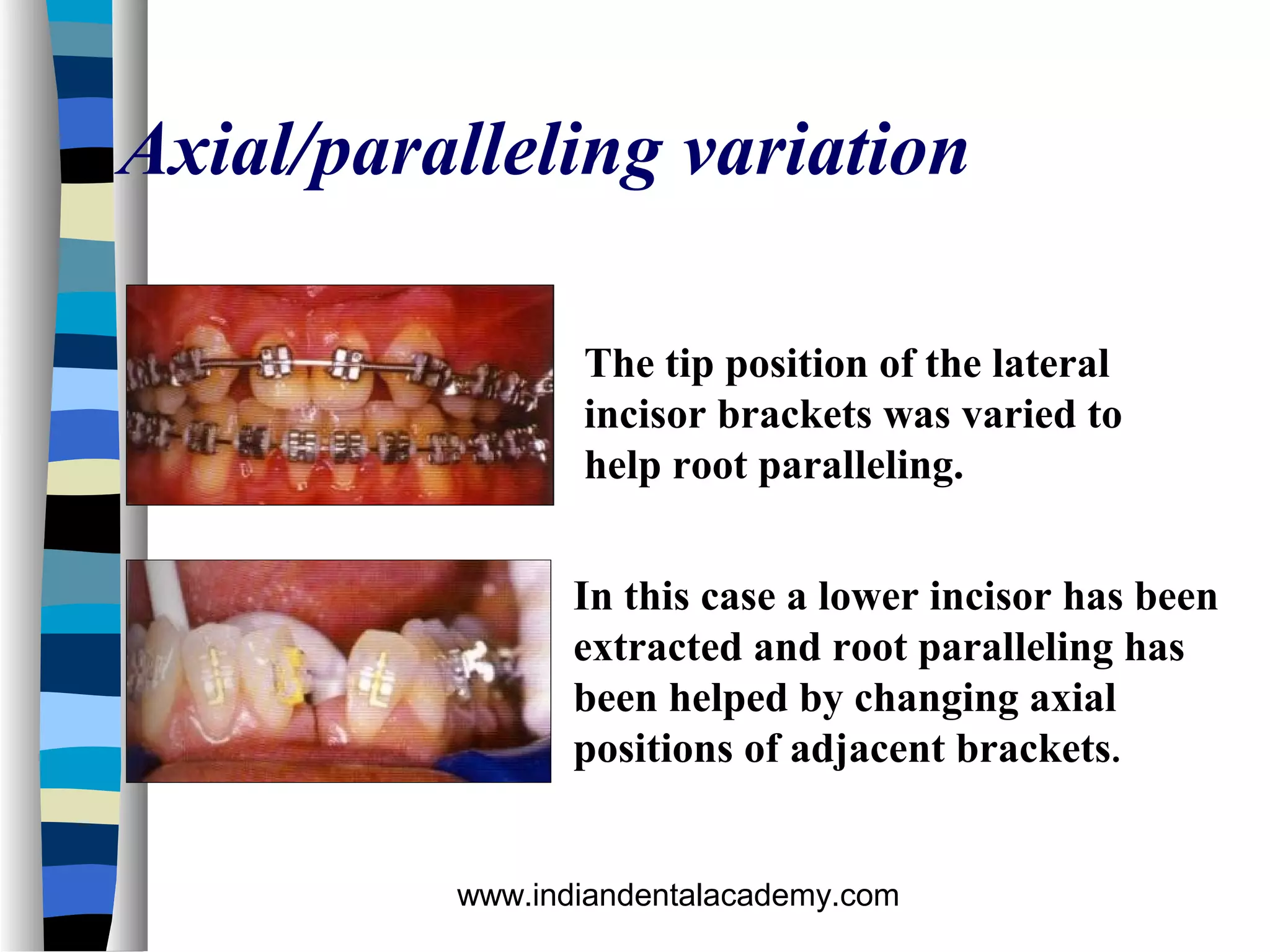 MBT system in orthodontics /certified fixed orthodontic courses by ...