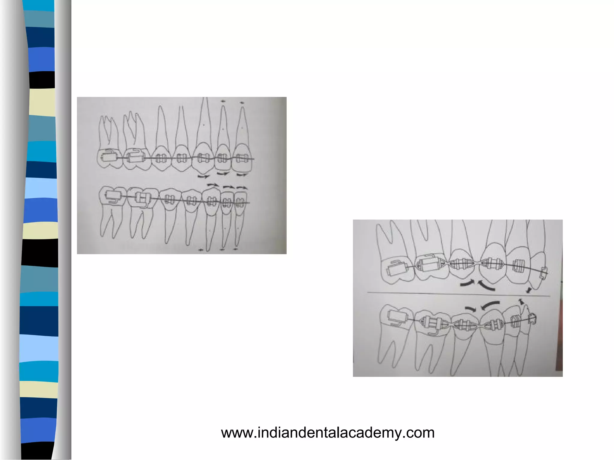 MBT system in orthodontics /certified fixed orthodontic courses by ...